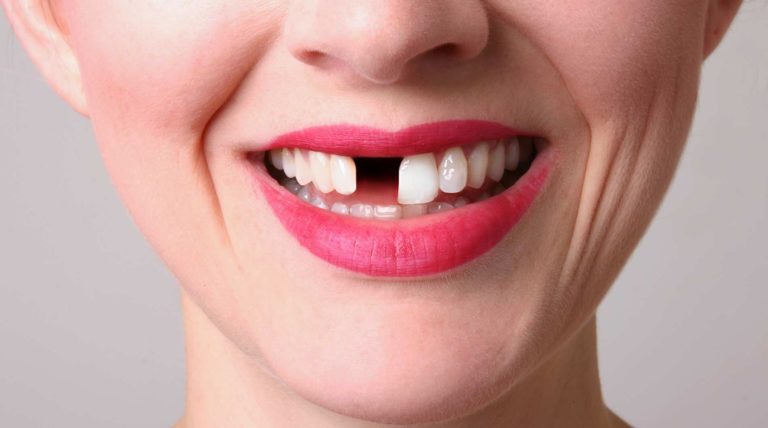 How to fix missing teeth | Bayview Dental Claremont, Perth